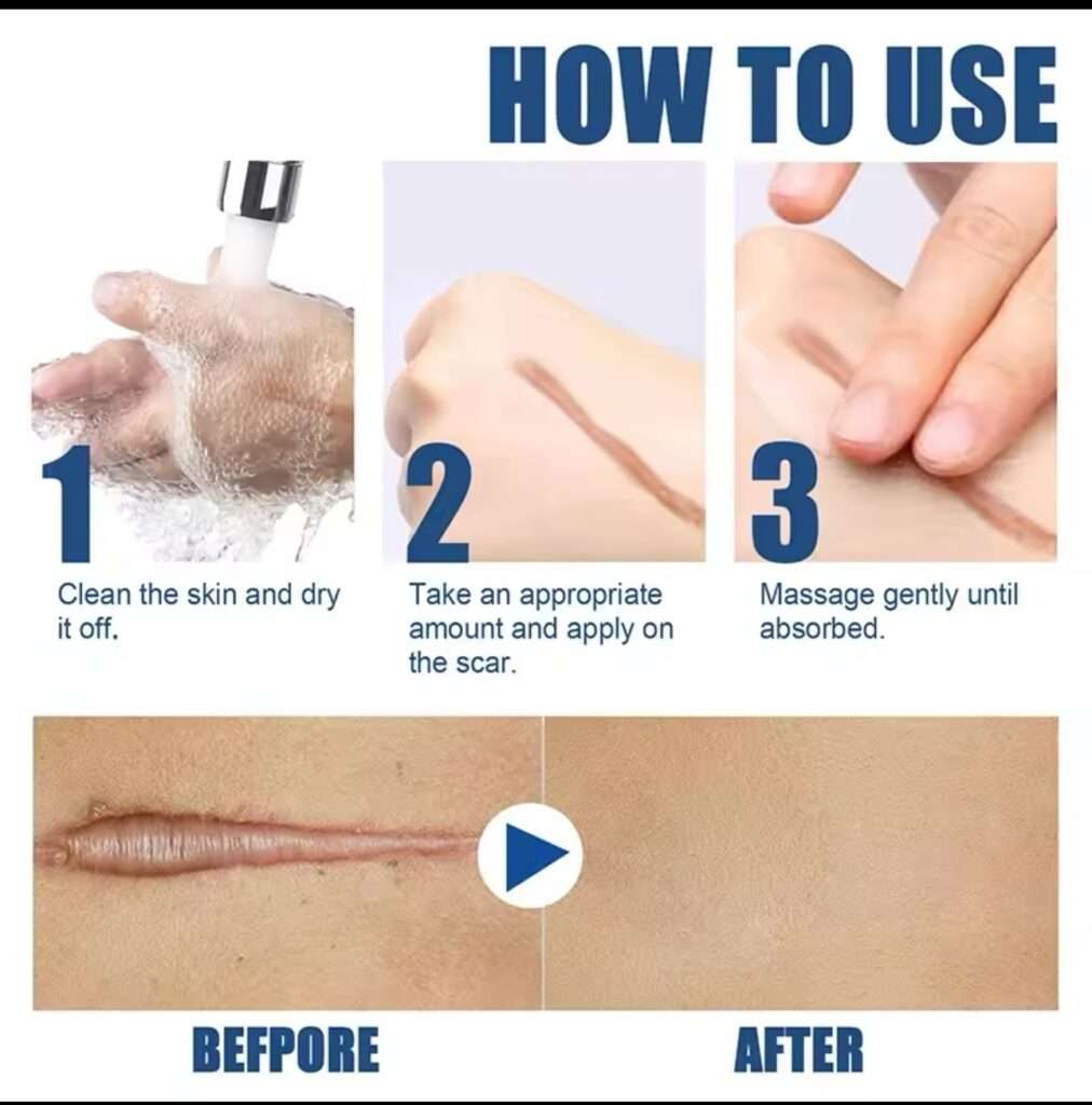 south moon scar remover - Brandstore