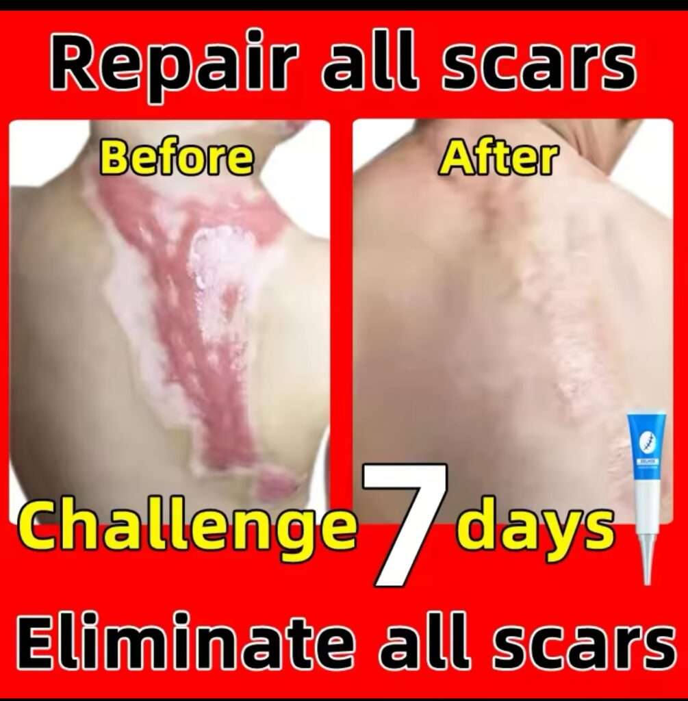 south moon scar remover - Brandstore